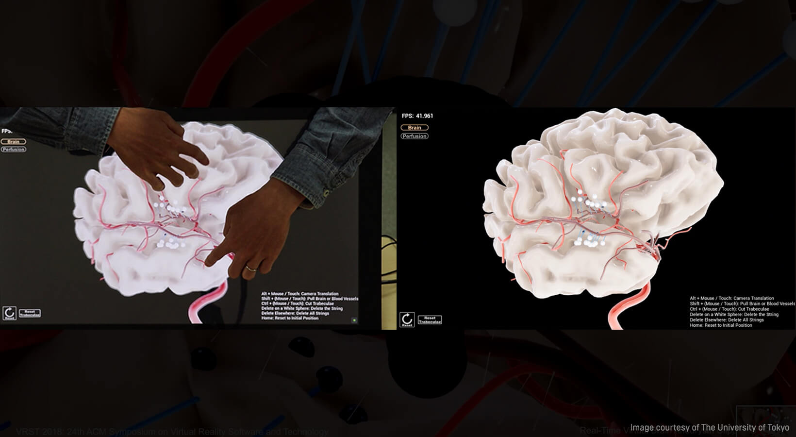 Helping brain surgeons practice with real-time simulation - Unreal Engine